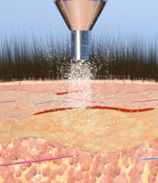 Empower IQ Delivery System